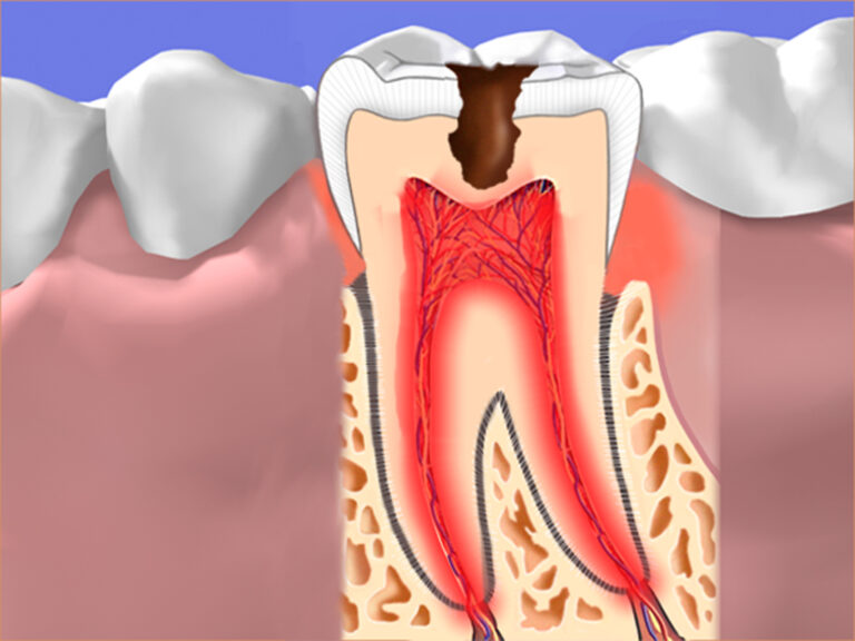 Rotfylling - Rødtvedt Tannhelsesenter AS