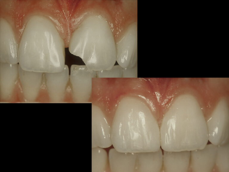 Reparere en tann - Rødtvedt Tannhelsesenter AS