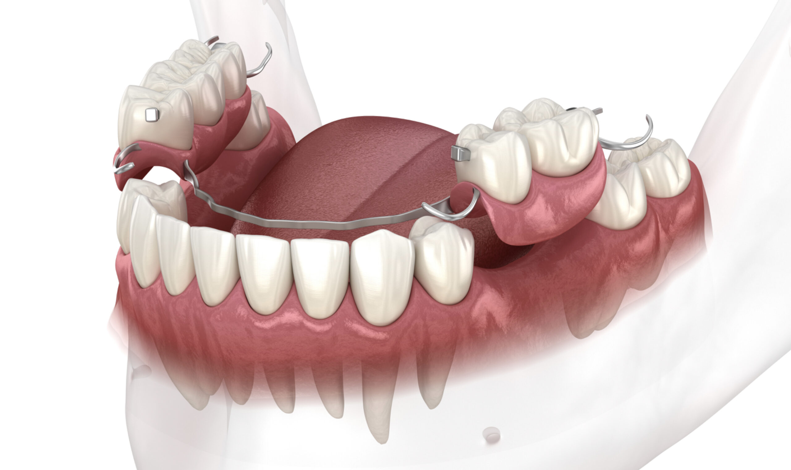 Delprotese - Rødtvedt Tannhelsesenter AS